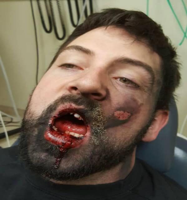Man loses seven teeth after vape explodes in his face