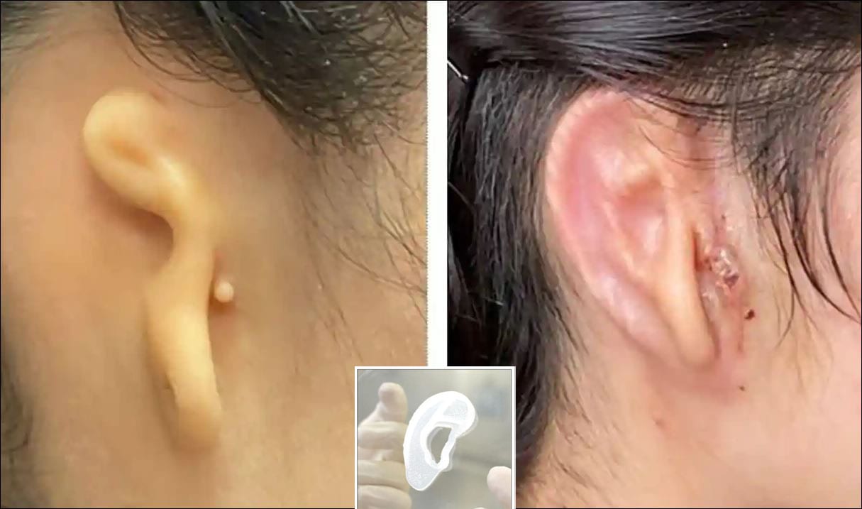 In a medical breakthrough, woman gets 3D printed ear implant made from ...