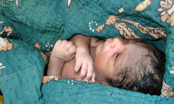 Baby born with two penises undergoes surgery in Pakistan