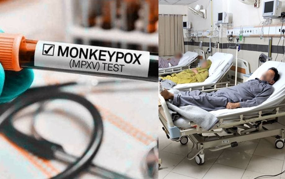 Two suspected cases of monkeypox reported in Lahore
